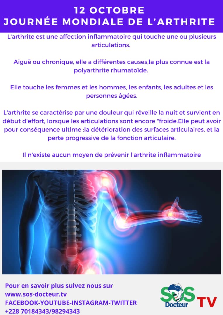 Comprendre l’arthrite, une atteinte inflammatoire des articulations ...